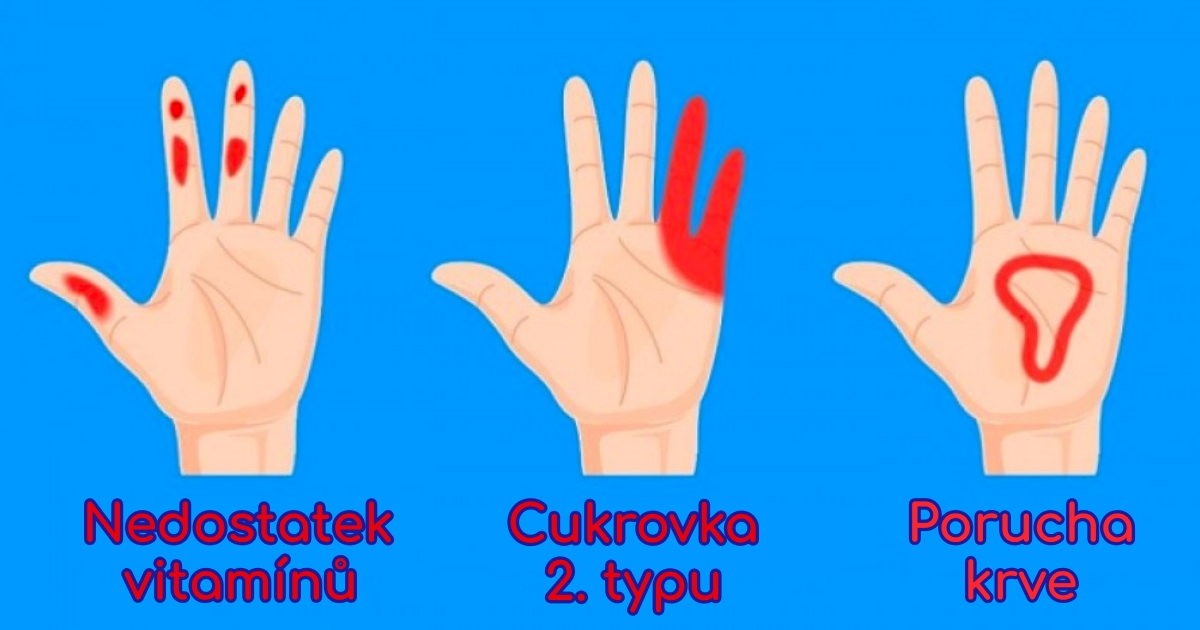 Co dlaně vypovídají o celkovém zdraví | JakZdravě.cz