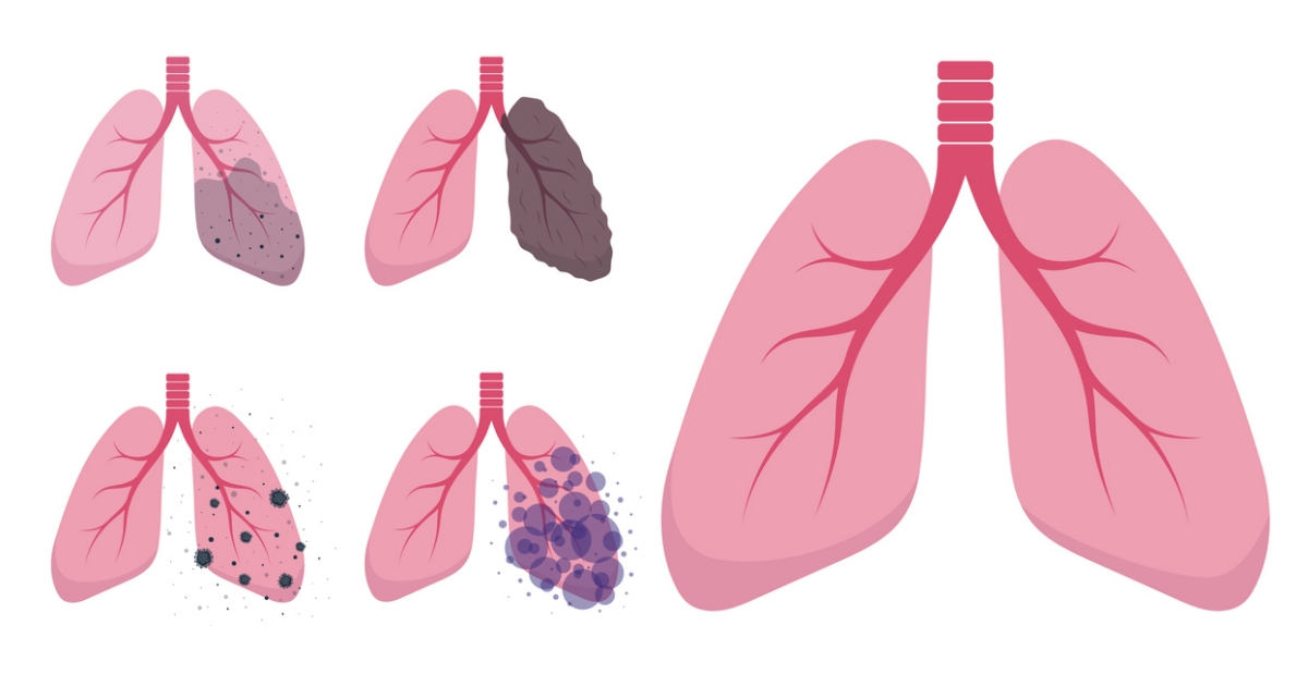 5 bylin, které podporují zdraví a funkci plic | JakZdravě.cz