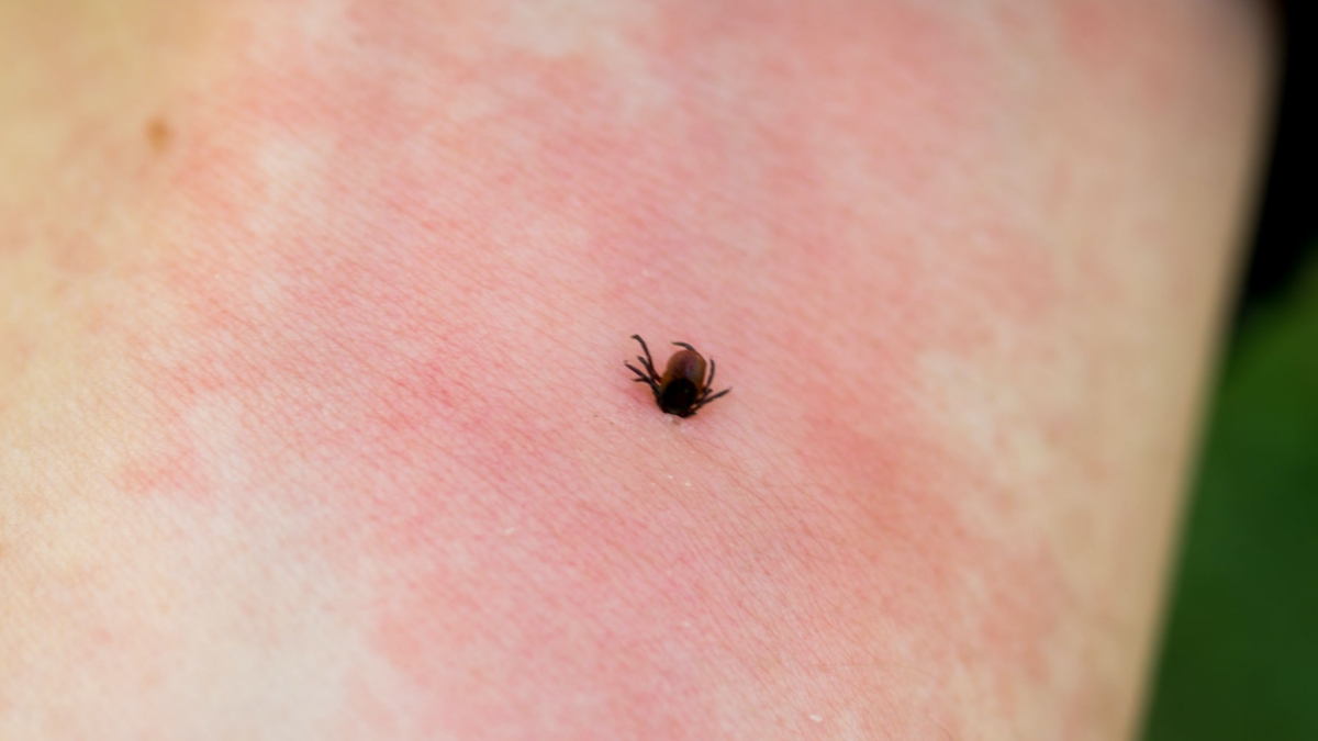 Jak bezpečně léčit kousnutí od klíštěte | JakZdravě.cz