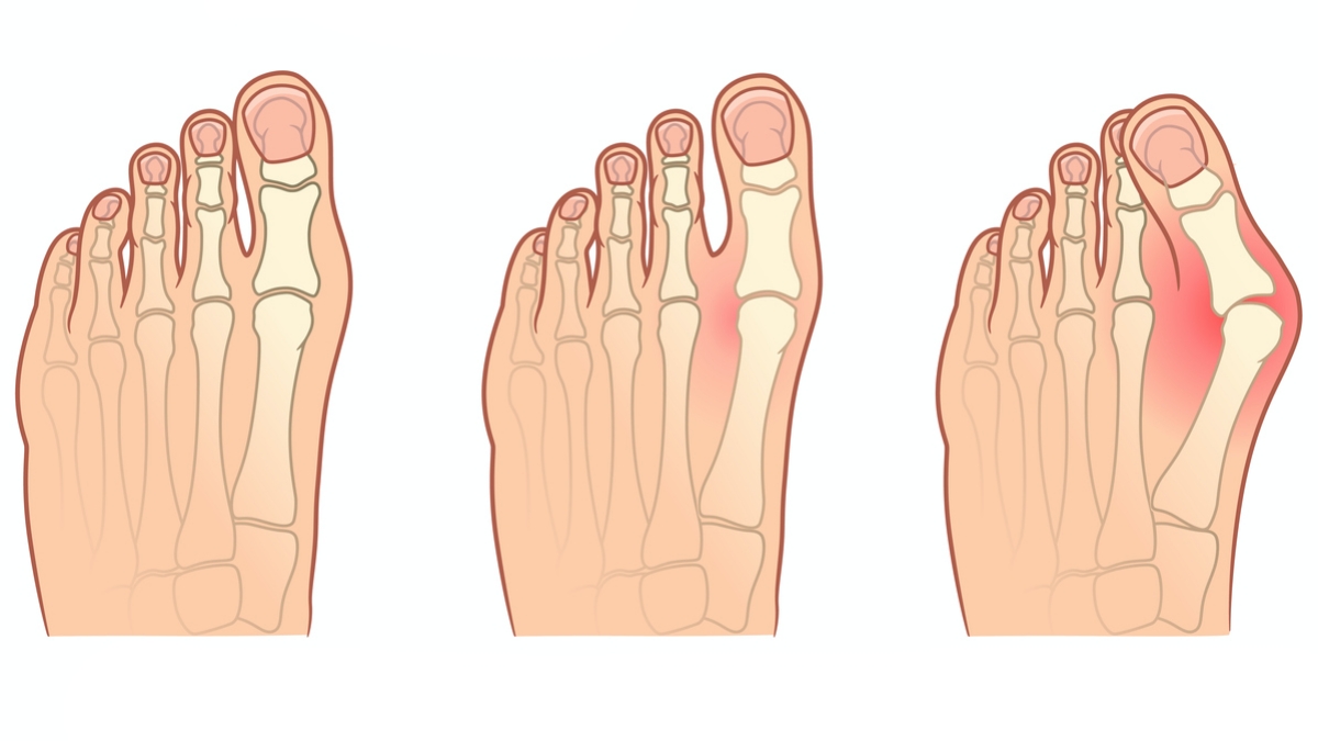 Léčba vbočeného palce a jak mu předcházet | JakZdravě.cz