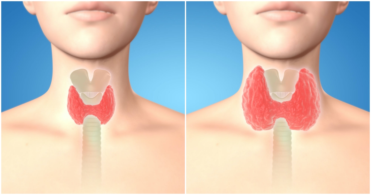 Hubnutí při nedostatečné funkci štítné žlázy | JakZdravě.cz
