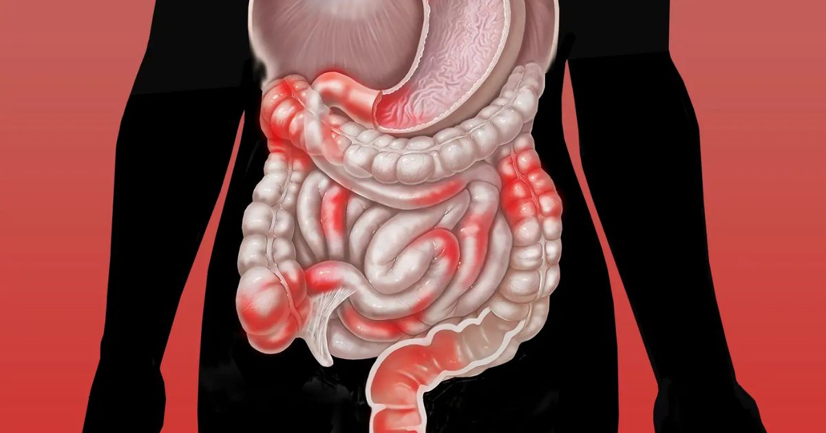 5 časných příznaků Crohnovy choroby | JakZdravě.cz