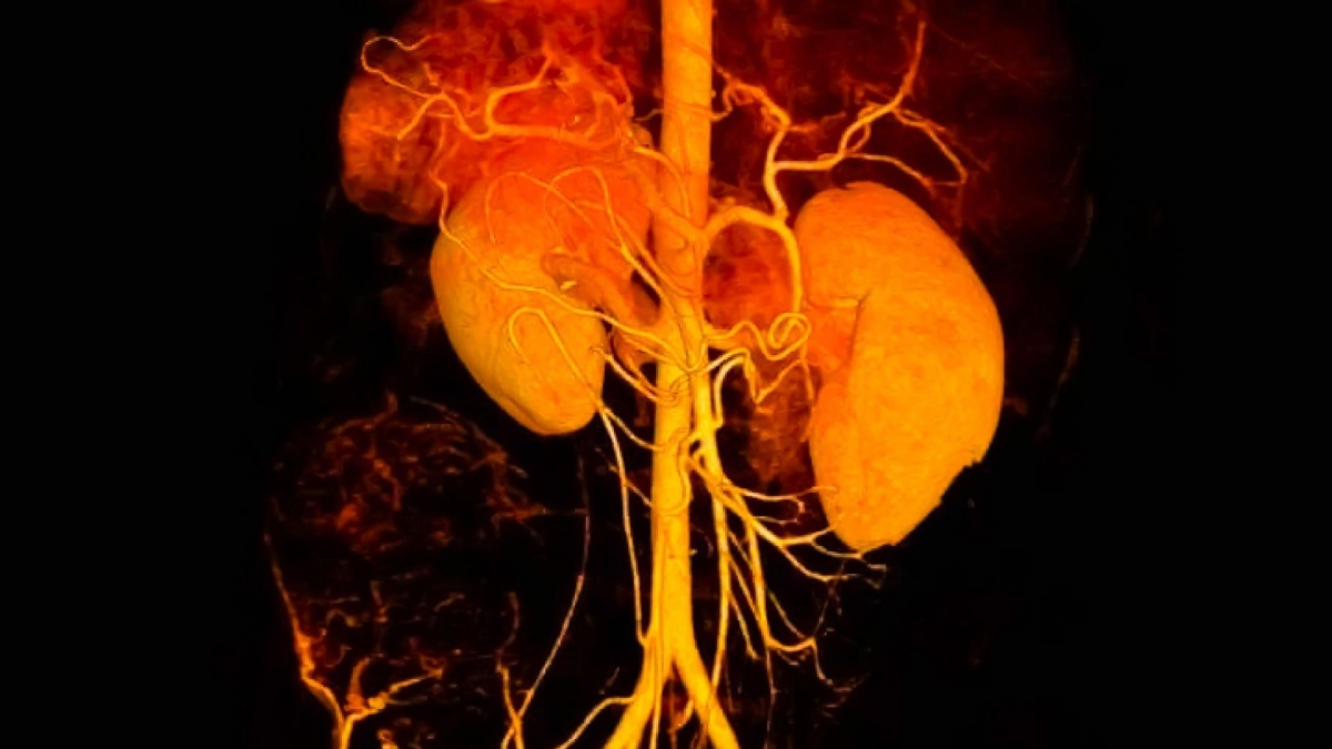 Rakovina ledvin: Jaké příznaky by vás měly varovat