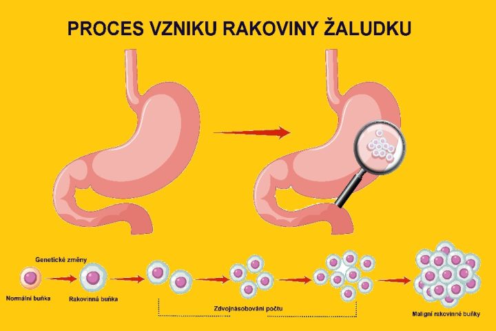 Rakovina žaludku - příznaky, diagnóza a léčba | JakZdravě.cz