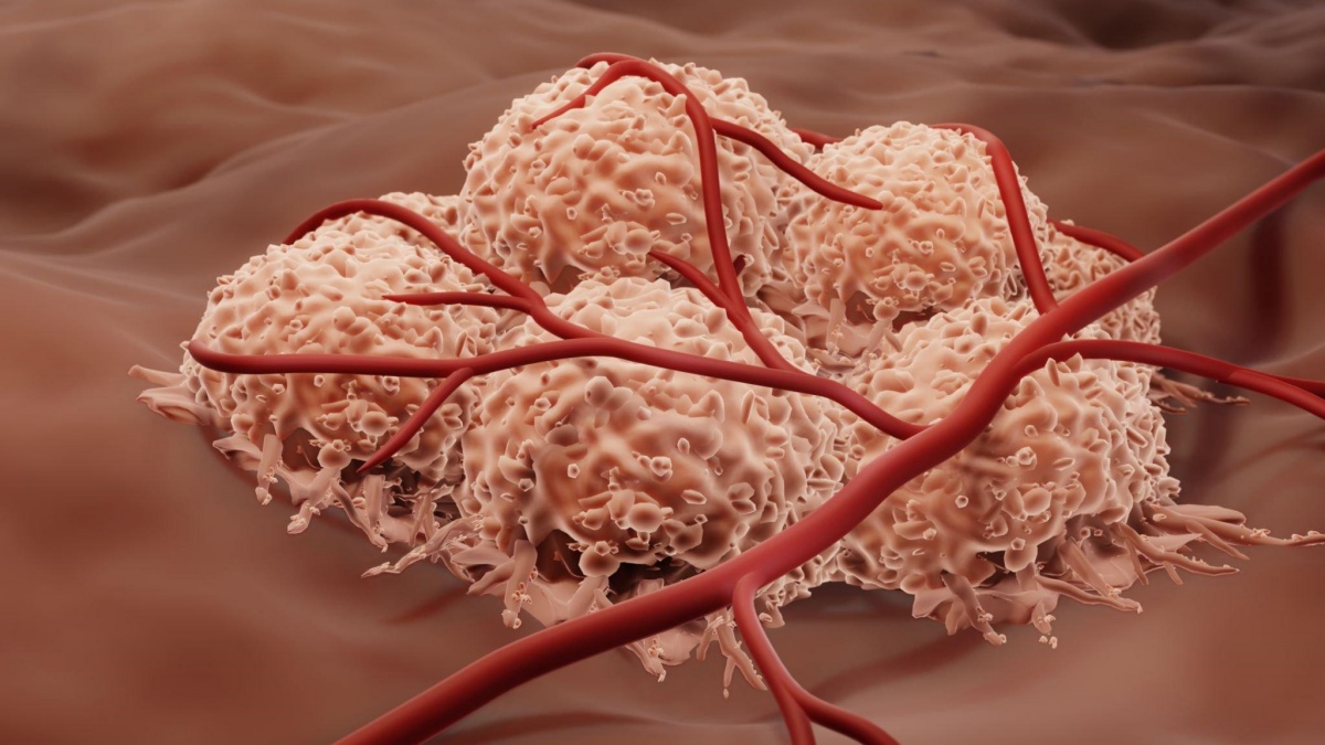 Ewingův sarkom: Příznaky a léčba této vzácné rakoviny