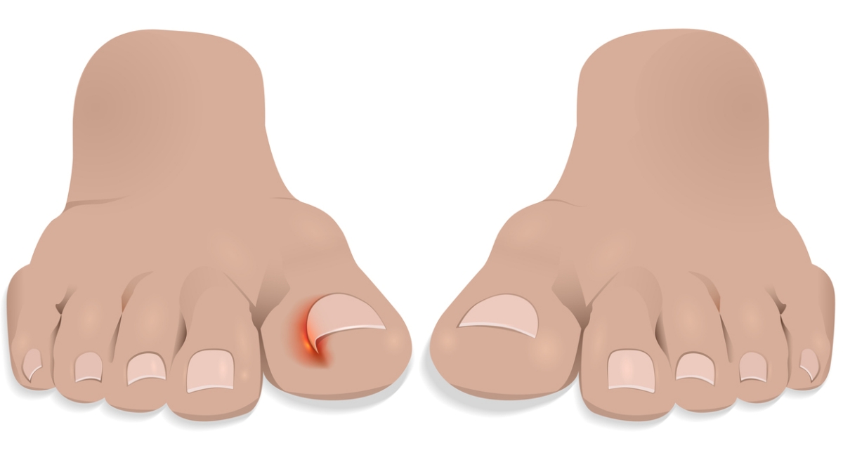 Jak se bezbolestně zbavit zarostlých nehtů sám doma během 30 minut