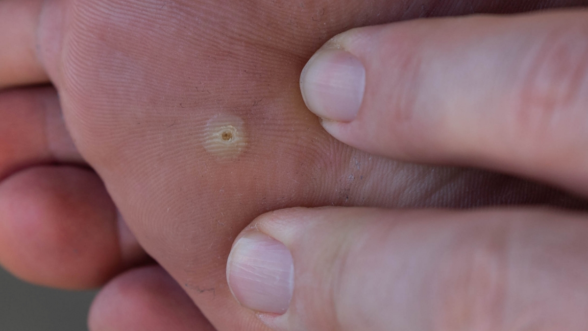 Jak odstranit bradavice z pohodlí domova a zcela přirozeně