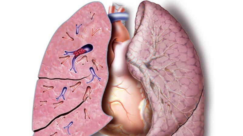 8 příznaků plicní embolie, které se nesmí podceňovat. Pak už to jde rychle