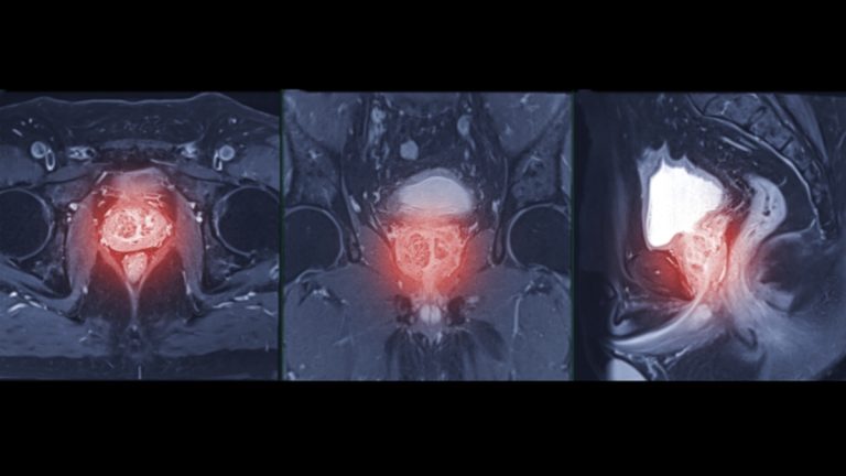 Příznaky rakoviny prostaty si včas uvědomí jen 2 z 10 mužů