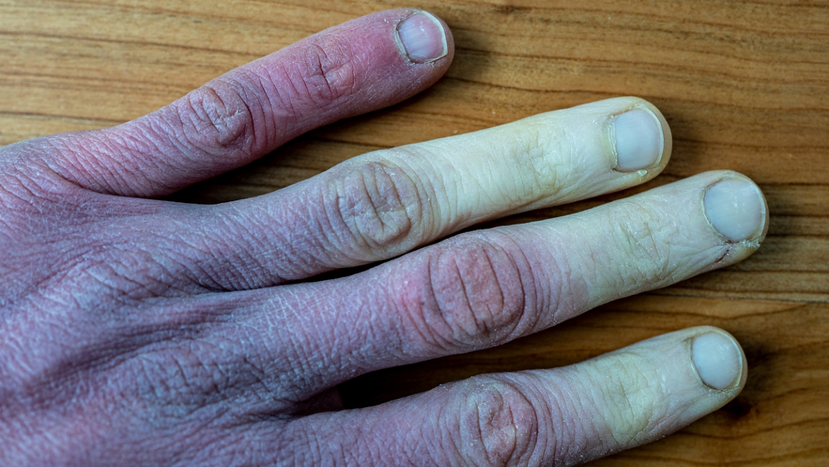 Raynaudova choroba je děsivá. Vše, co byste o ní měli vědět