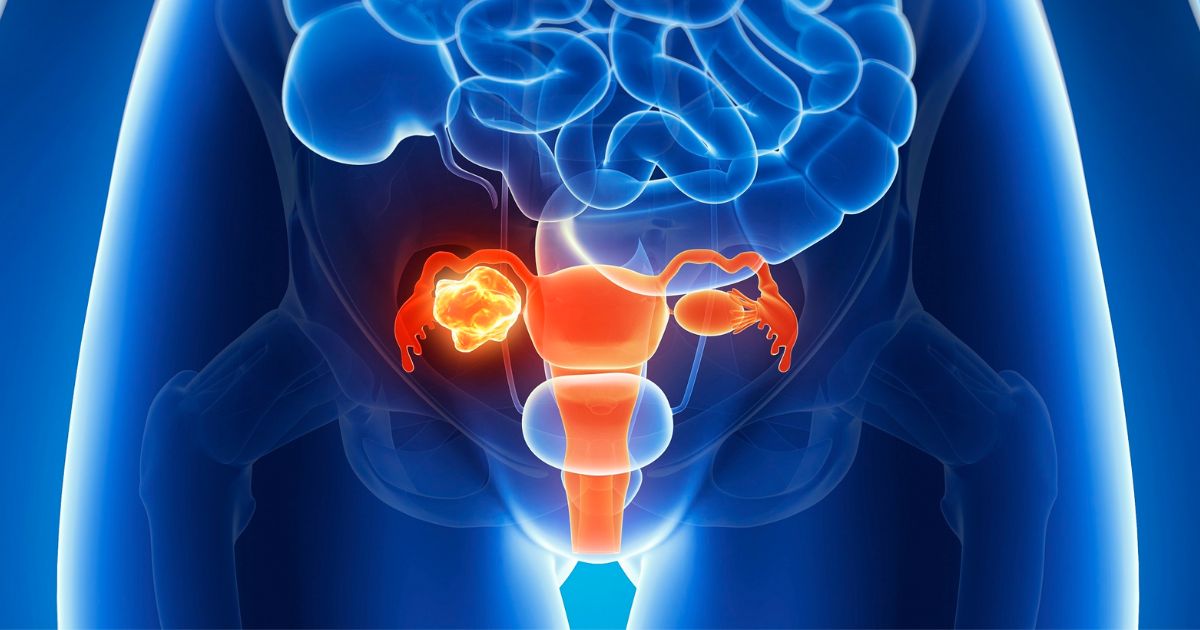 Příznaky rakoviny vaječníků, které ženy podceňují: Časté močení, bolest...