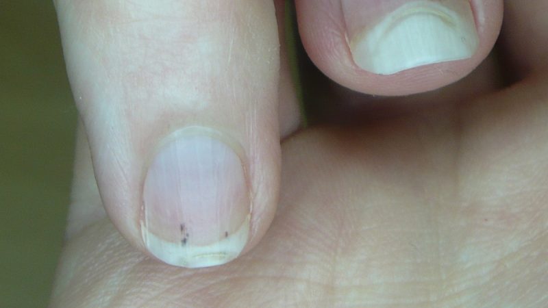 Červené skvrny pod nehty vás varují před vážným onemocněním