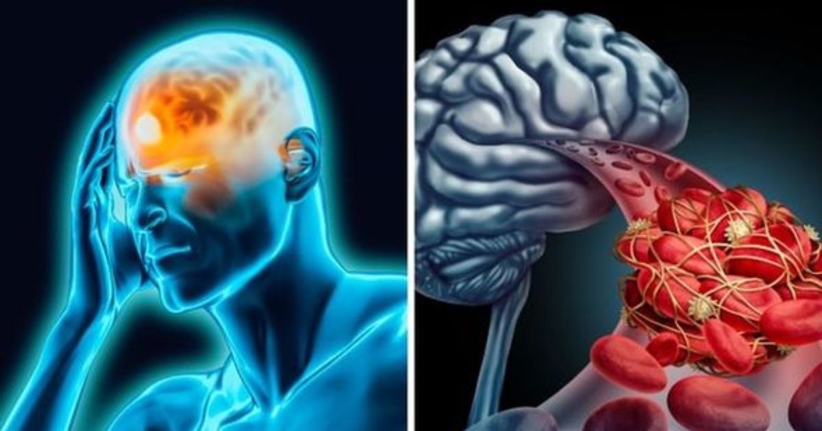 Mozková žilní trombóza: Její včasné odhalení je zásadní