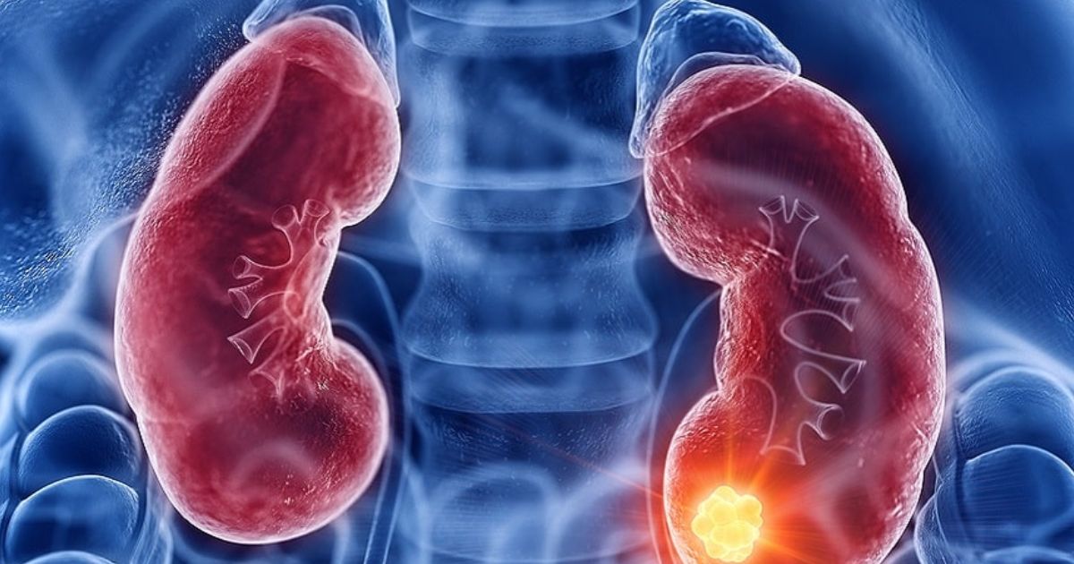 5 špatných návyků, kterými si každý den ničíte ledviny