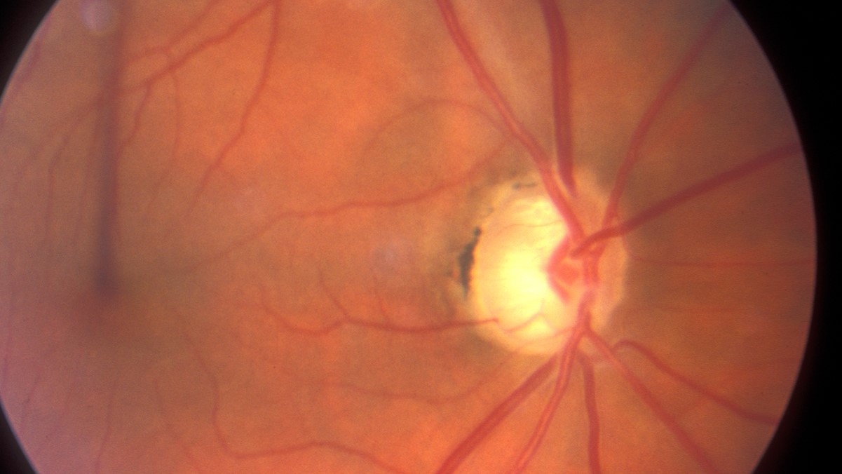 Máte zhoršené periferní vidění? Může jít o zelený zákal