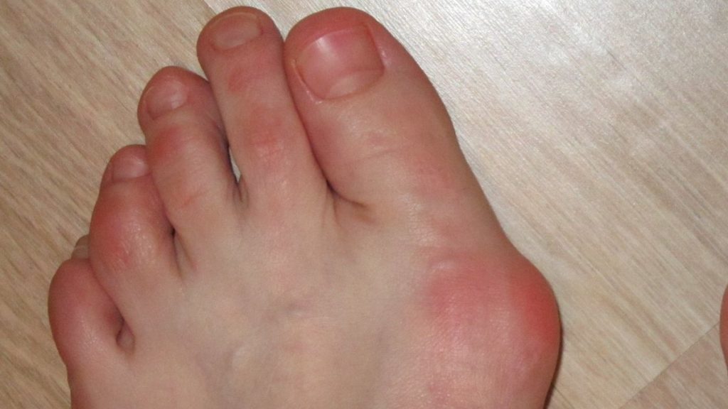 Nejčastější příčiny vbočeného palce a domácí léčba problému