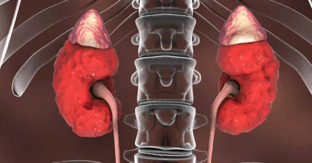 5 nejčastějších příznaků hypertenze a onemocnění ledvin