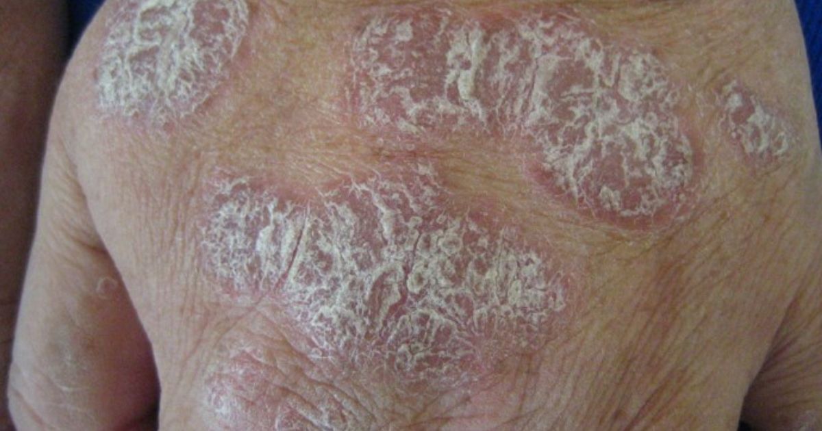 Tea tree olej a jeho léčivé účinky na různá kožní onemocnění