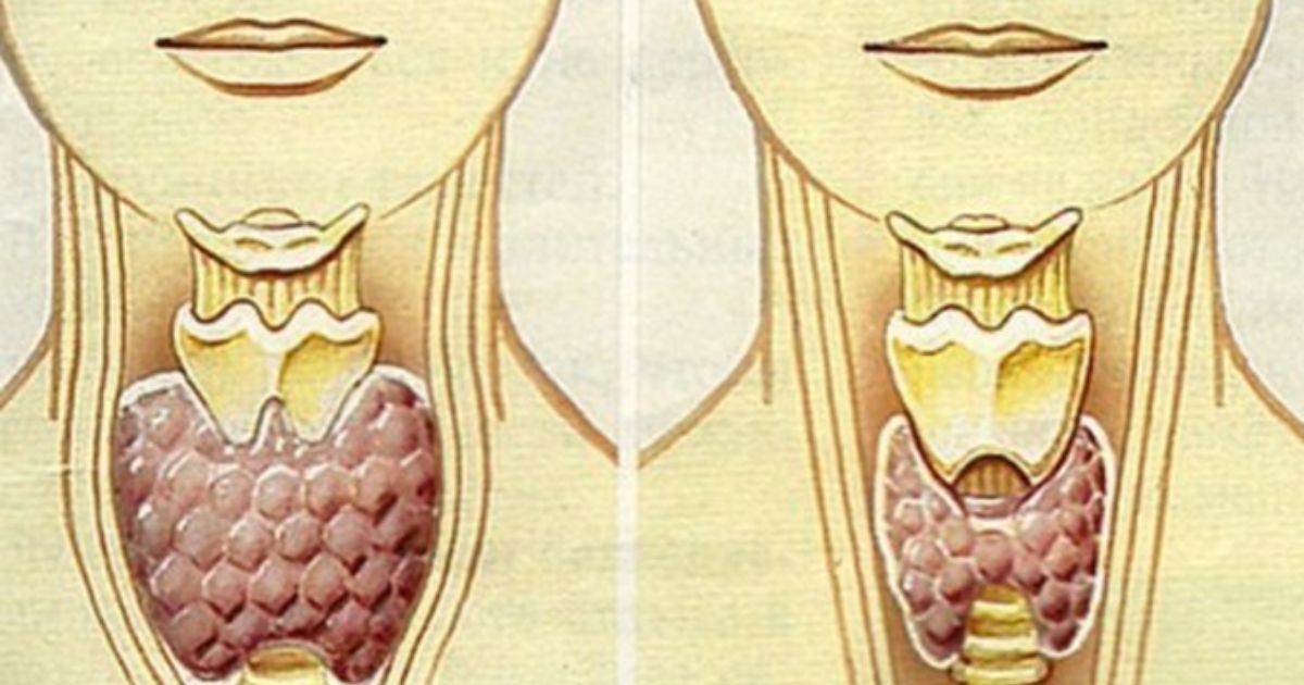 Nadměrnou funkci štítné žlázy lze léčit pohankou, ořechy a medem